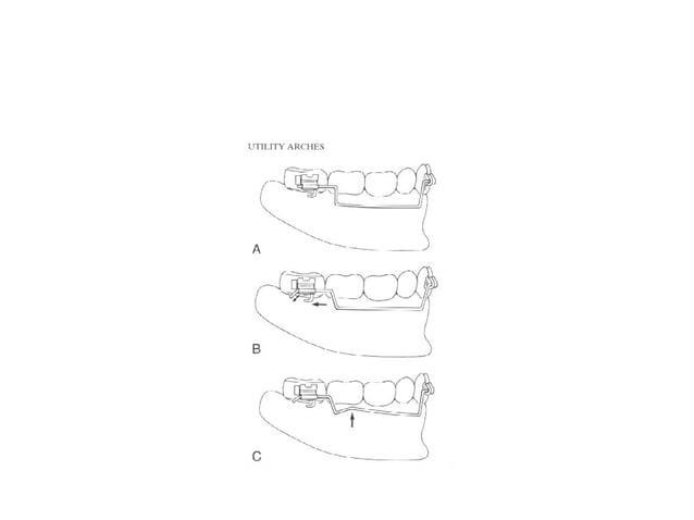 presentation on management of DEEP BITE, | PPT