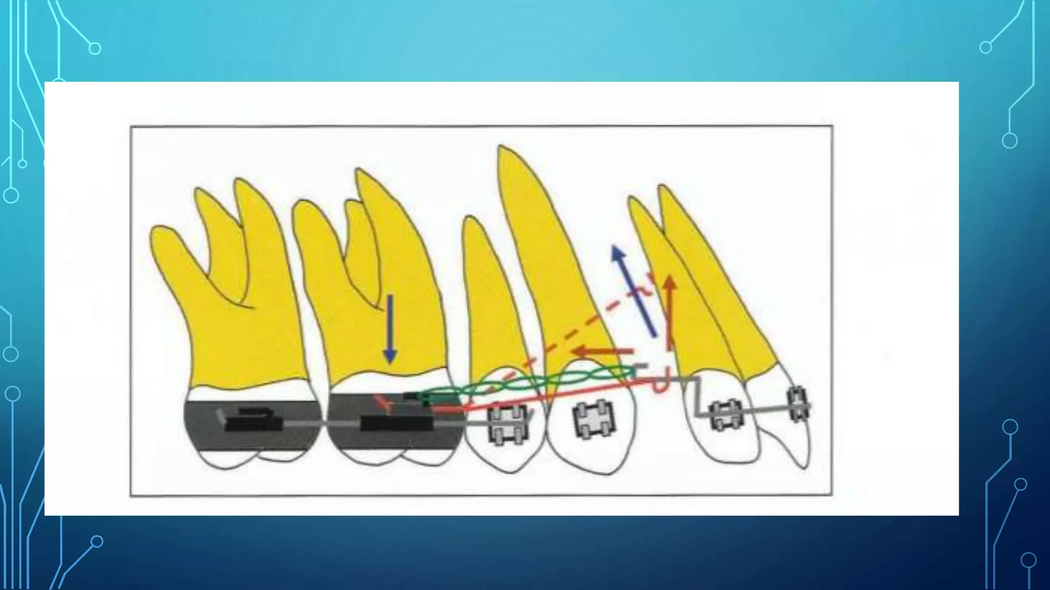 Intrusion arch | PPTX