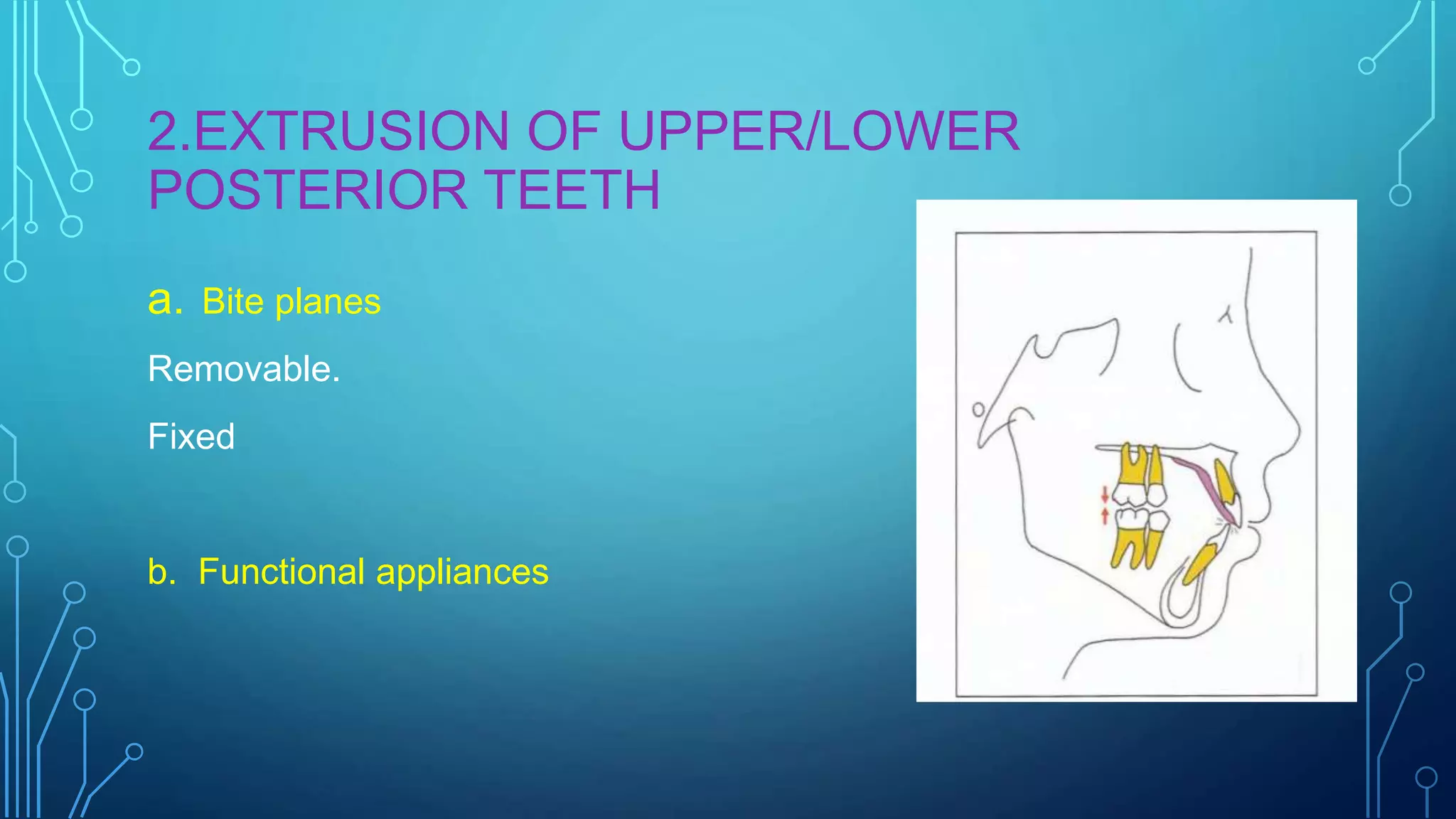 Intrusion arch | PPTX