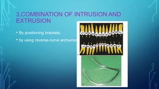 Intrusion arch | PPTX