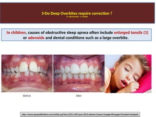Deep bite malocclusions-M. ABOULNASER- Orthodontist, BUA, USA. O ...