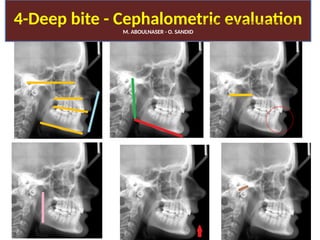 Deep bite malocclusions-M. ABOULNASER- Orthodontist, BUA, USA. O ...