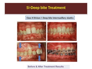 Deep bite malocclusions-M. ABOULNASER- Orthodontist, BUA, USA. O ...