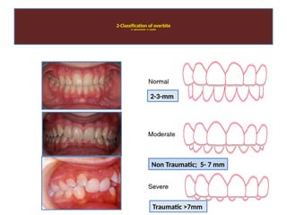 Deep bite malocclusions-M. ABOULNASER- Orthodontist, BUA, USA. O ...