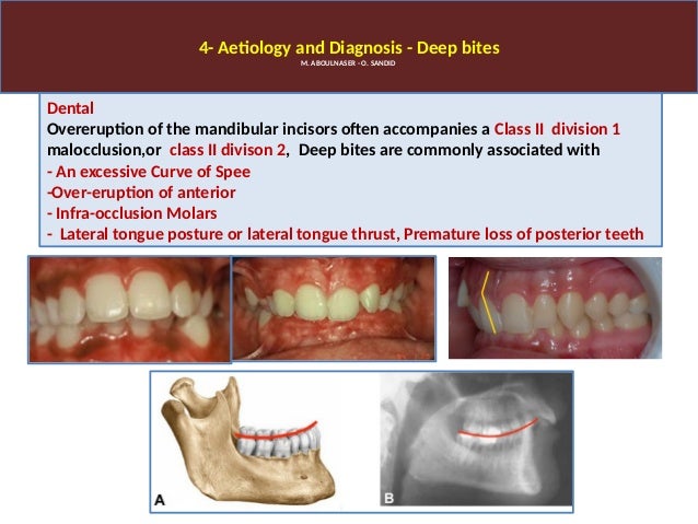 Deep bite malocclusions-M. ABOULNASER- Orthodontist, BUA, USA. O. SAN…