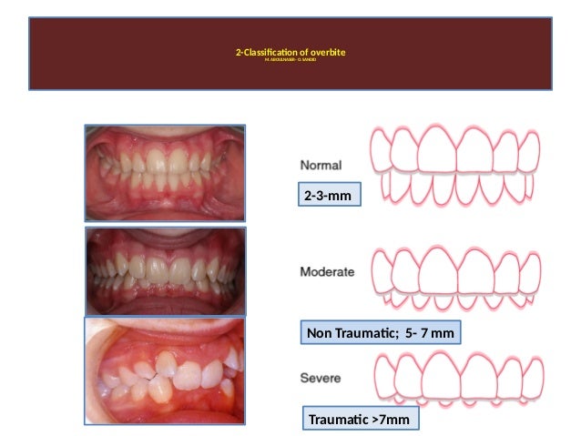 Deep bite malocclusions-M. ABOULNASER- Orthodontist, BUA, USA. O. SAN…