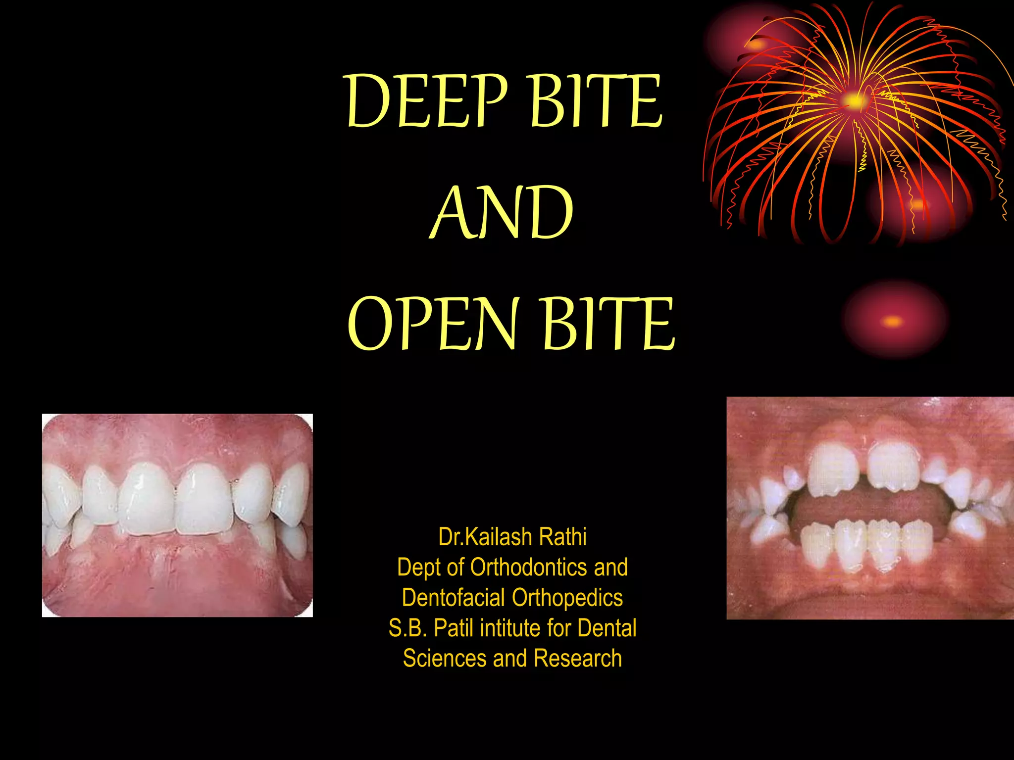 Deep bite & Open bite | PPT