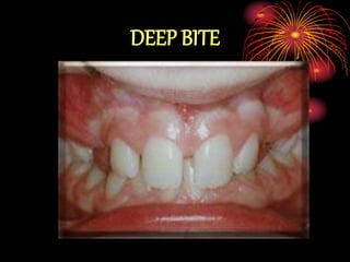 Deep bite & Open bite | PPT