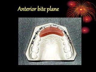Deep bite & Open bite | PPT