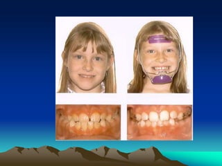 Deep bite & Open bite | PPT