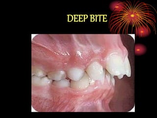 Deep bite & Open bite | PPT