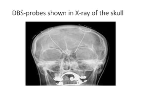 Deep brain stimulation | PPTX