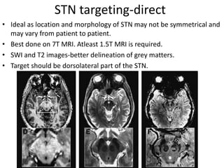 Deep Brain Stimulation | PPTX