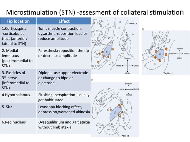 Deep Brain Stimulation | PPTX