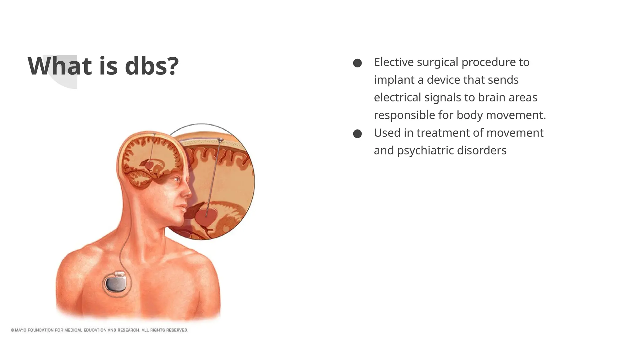 deep brain stimulation presentation.pptx