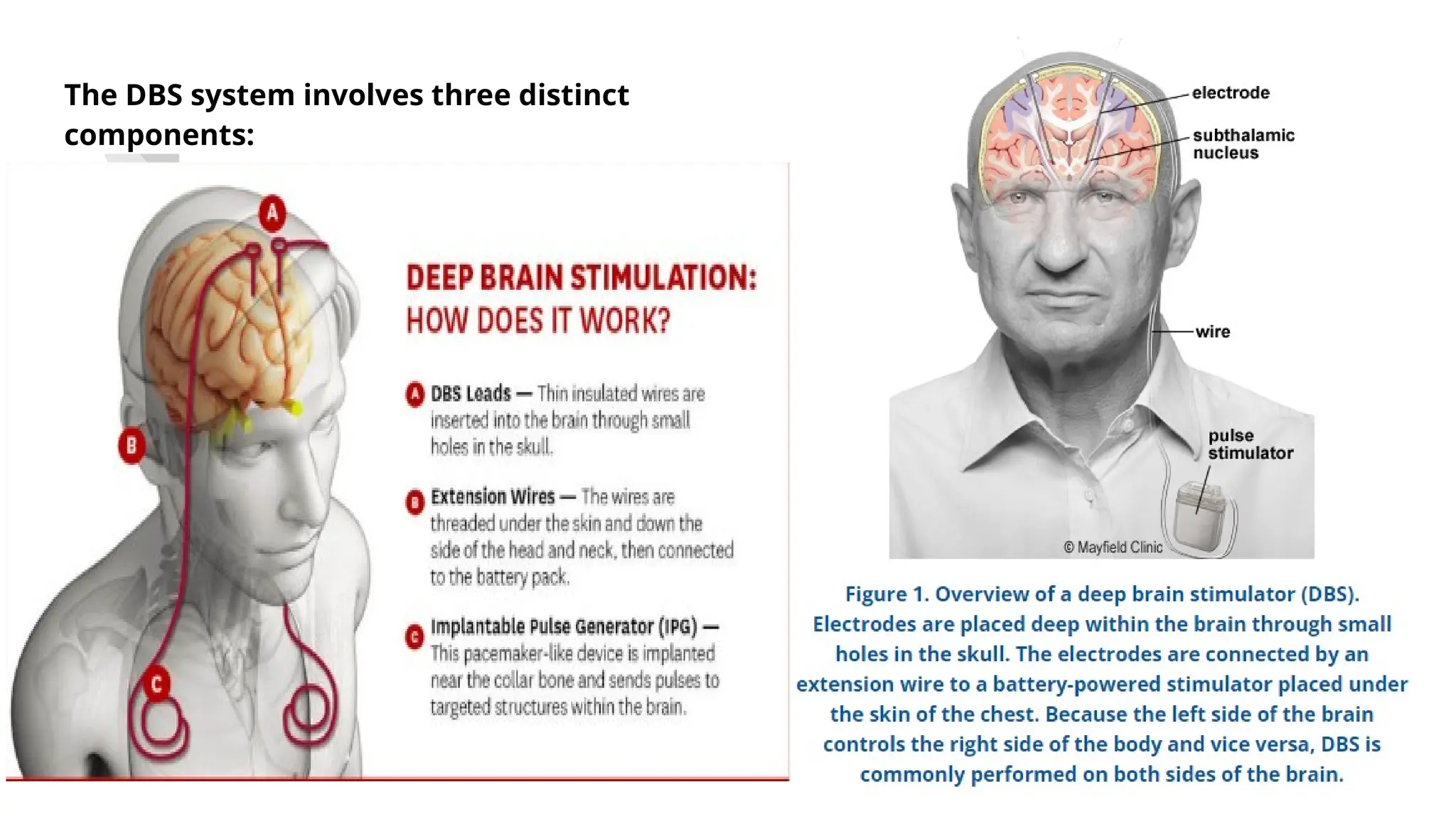 deep brain stimulation presentation.pptx