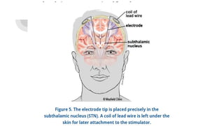 deep brain stimulation presentation.pptx
