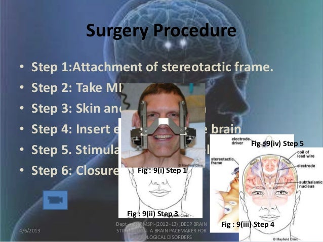 Deep brain stimulation