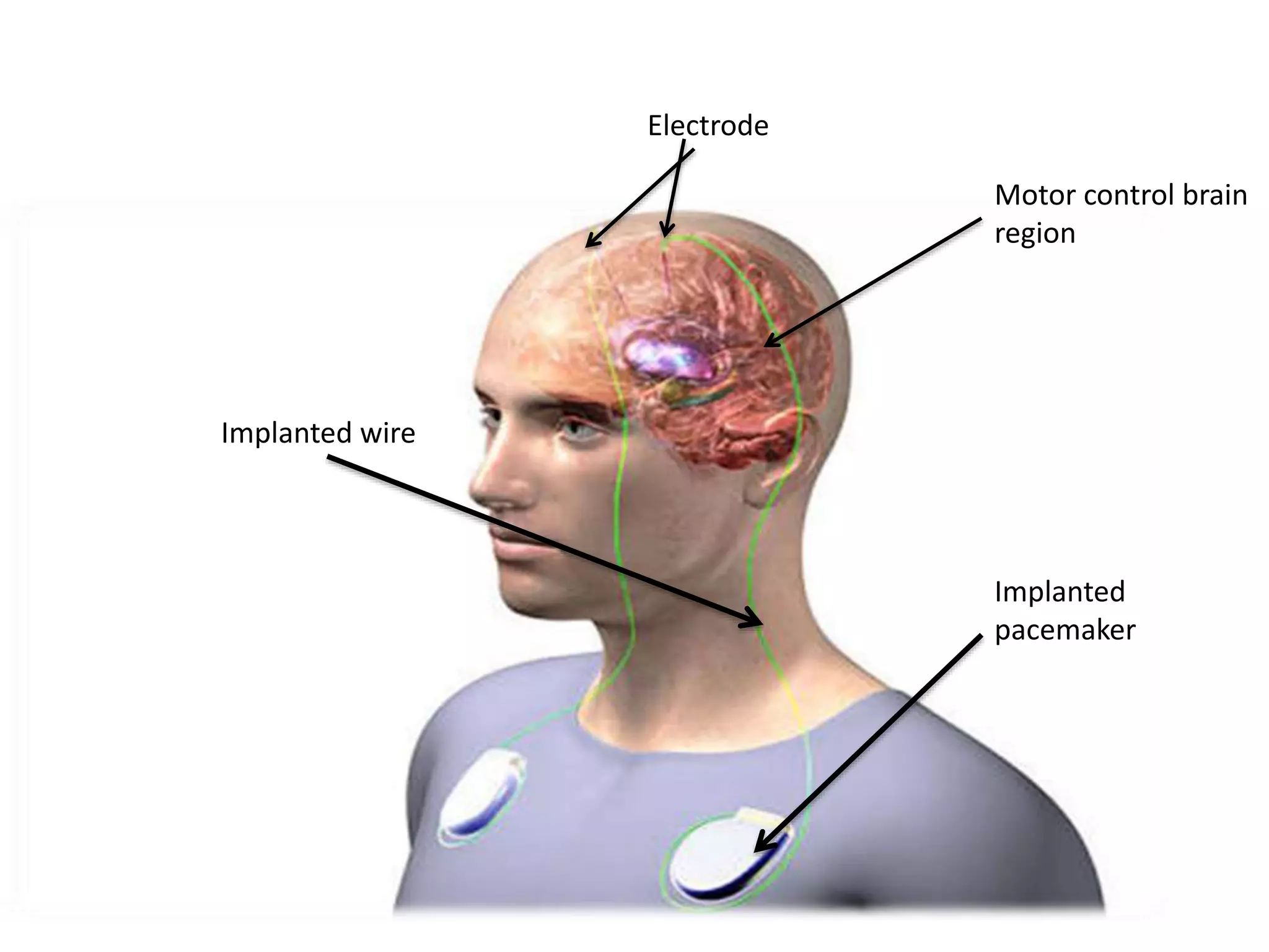Deep brain stimulators ppt | PPTX | Brain and Nervous System Disorders ...