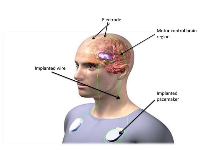 Deep brain stimulators ppt | PPTX | Brain and Nervous System Disorders ...