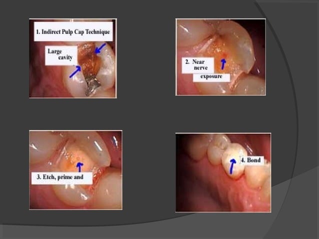 Deep caries management | PPT | Oral care | Personal Care