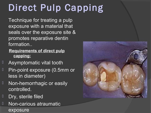 Deep caries management | PPT | Oral care | Personal Care