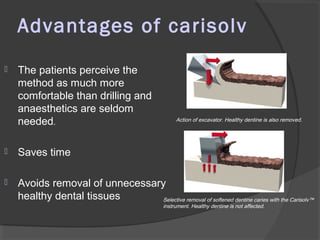 Deep caries management | PPT