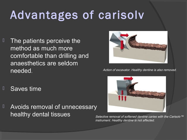 Deep caries management | PPT | Oral care | Personal Care