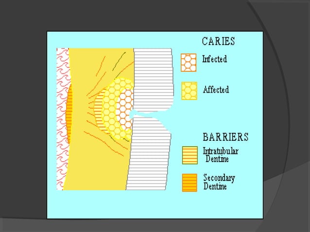 Deep caries management | PPT | Oral care | Personal Care