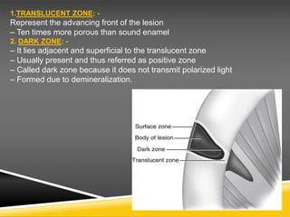 management of deep seated caries | PPTX