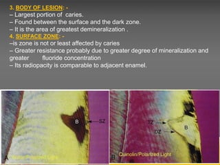 management of deep seated caries | PPTX