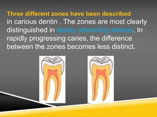 management of deep seated caries | PPTX