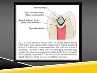 management of deep seated caries | PPTX