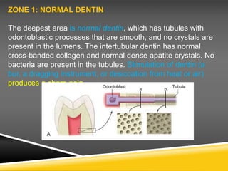 management of deep seated caries | PPTX
