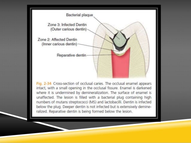 management of deep seated caries