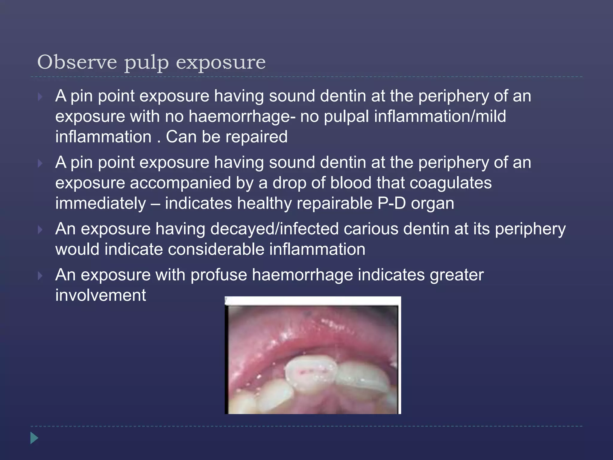 Deep carious lesions | PPTX