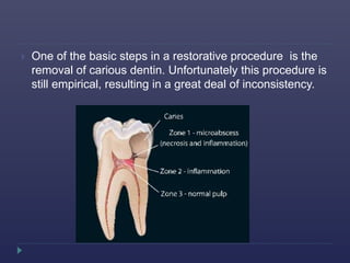 Deep carious lesions | PPTX