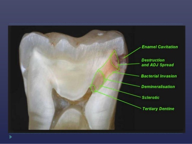 Deep carious lesions