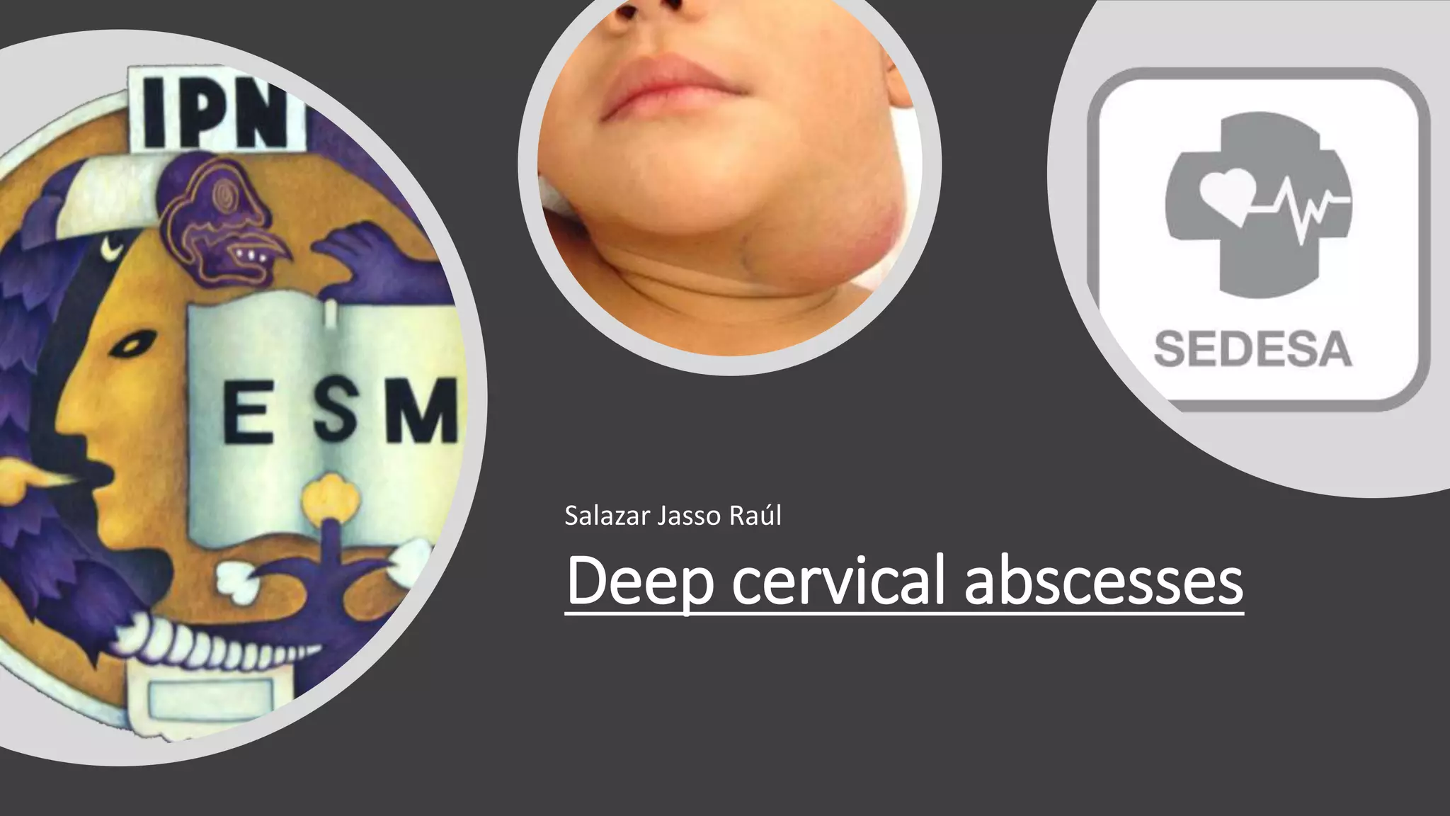 Deep cervical abscesses | PPTX