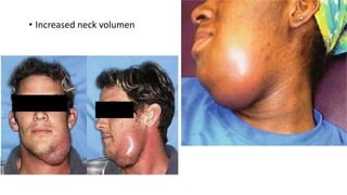 Deep cervical abscesses | PPTX