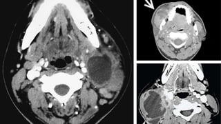 Deep cervical abscesses | PPTX