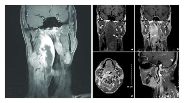 Deep cervical abscesses | PPT | Free Download