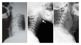 Deep cervical abscesses | PPTX