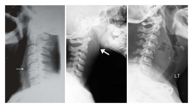 Deep cervical abscesses | PPTX