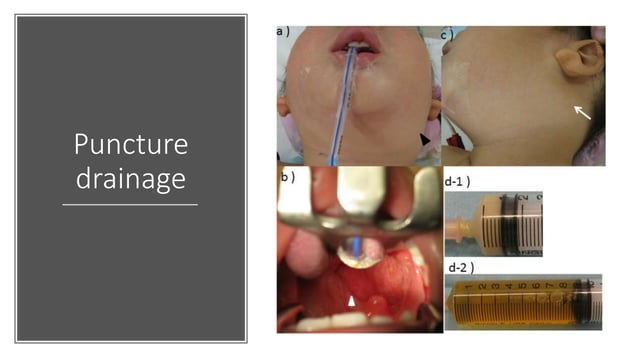 Deep cervical abscesses | PPTX