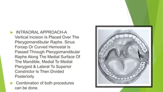 Deep facial spaces of head and neck | PPTX