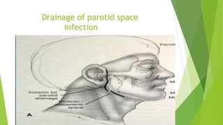 Deep facial spaces of head and neck | PPTX