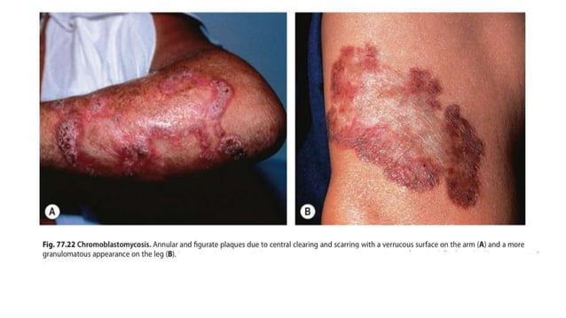 Deep fungal infection.pptx | Skin and Dermatology | Diseases and Conditions
