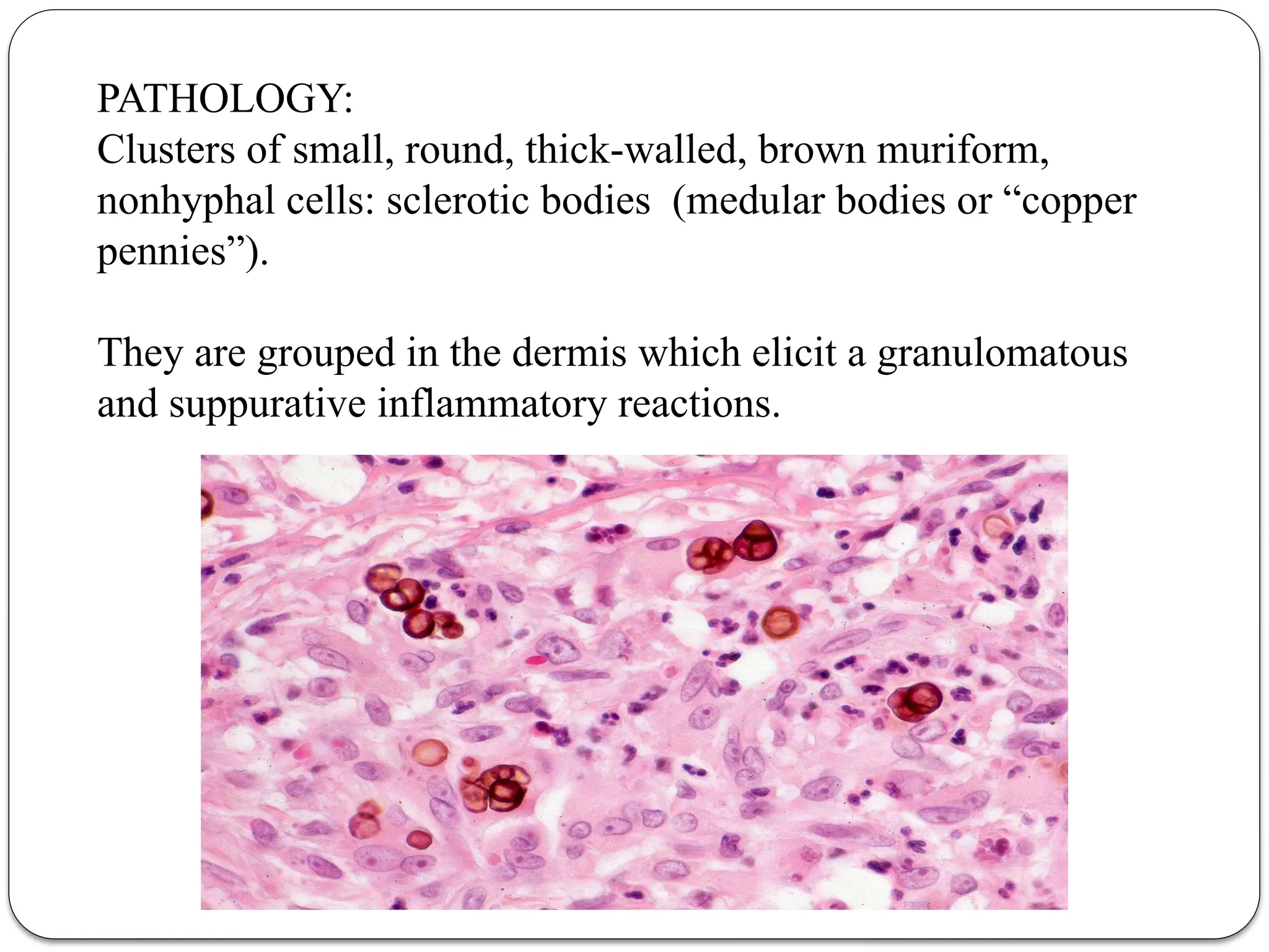 DEEP FUNGAL INFECTIONS-Candida, Aspergillus | PPTX