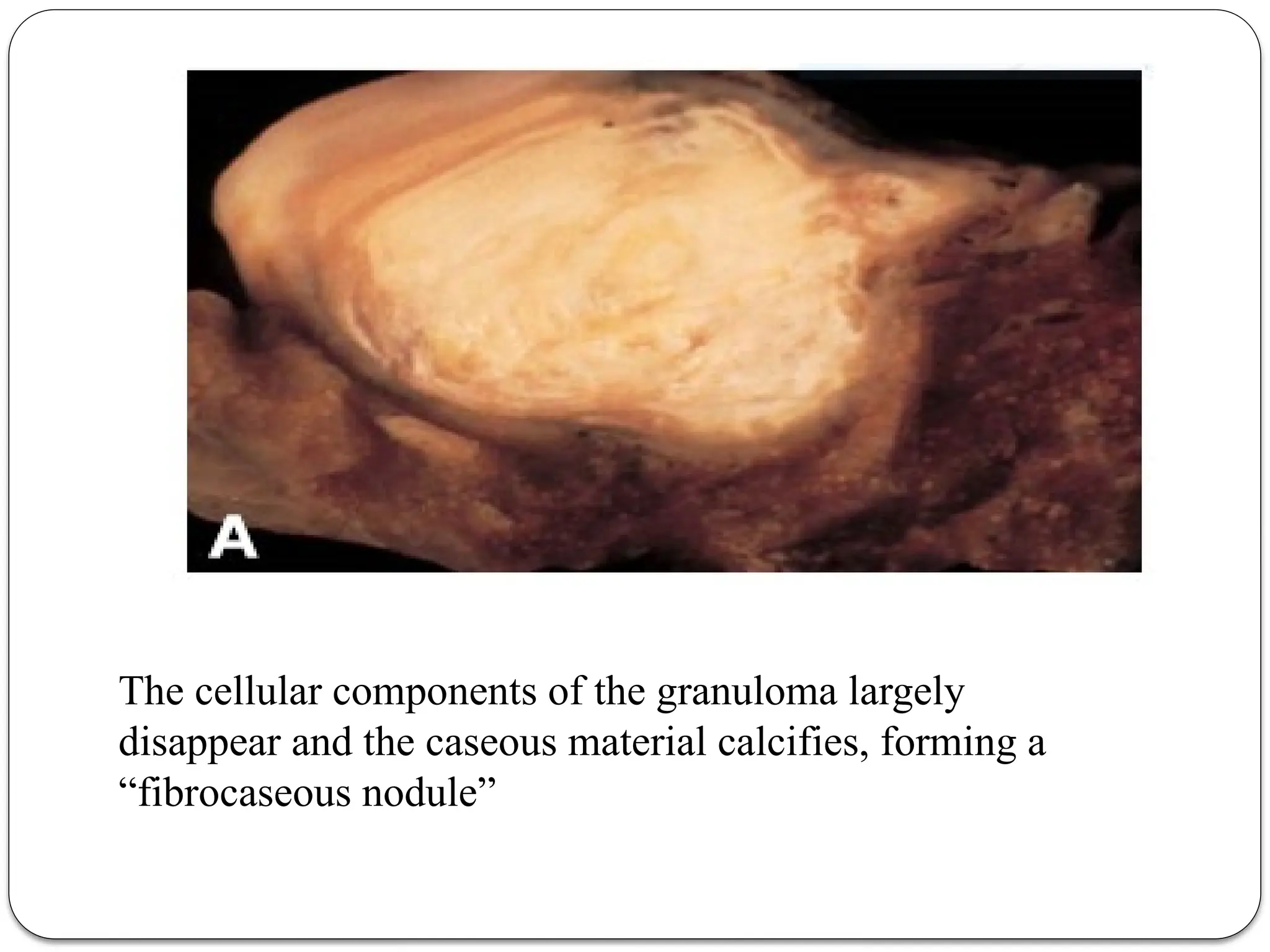 DEEP FUNGAL INFECTIONS-Candida, Aspergillus | PPTX
